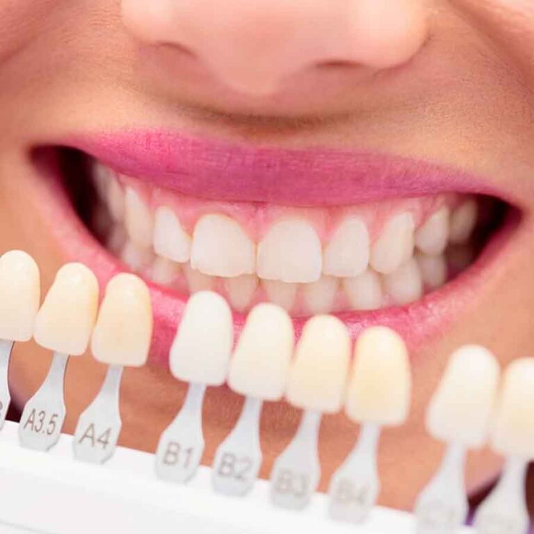 Resina Dental: Todo lo que Necesitas Saber sobre este Material Versátil